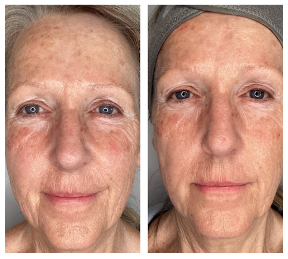 Neveskin Face™ - Boost Collagen & Elastin Production | Artemis